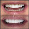 Complete Guide to Composite Bonding - Lighthouse Dental Practice