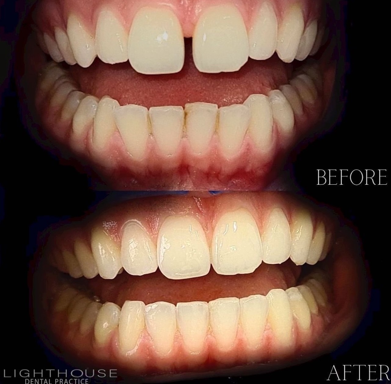 Embracing Smiles with Invisalign - Lighthouse Dental Practice